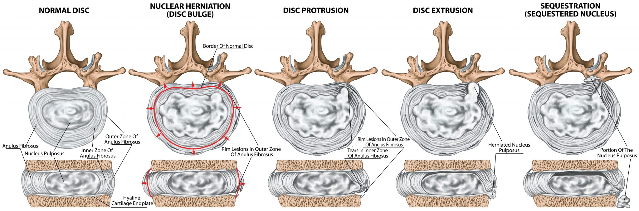 MANUAL FLEXION-DISTRACTION THERAPY – OrthoAthlete